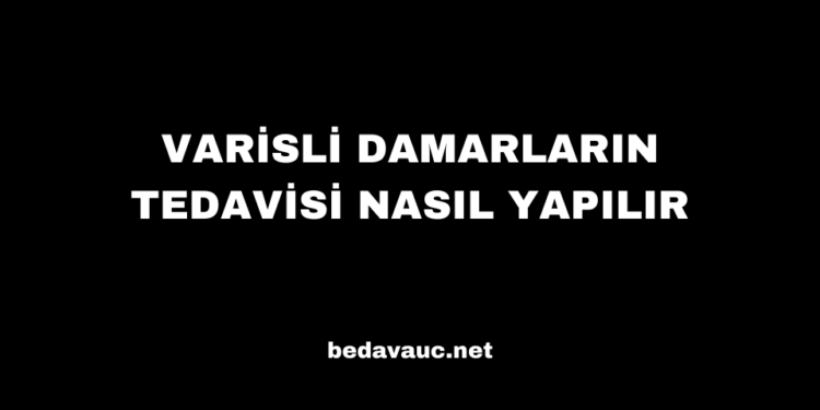 Varisli Damarların Tedavisi Nasıl Yapılır - BEDAVA UC